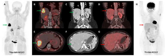 FAPI PET/CT Imaging—An Updated Review