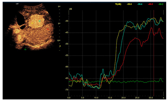Usefulness of Contrast-Enhanced Ultrasound in the Differentiation ...