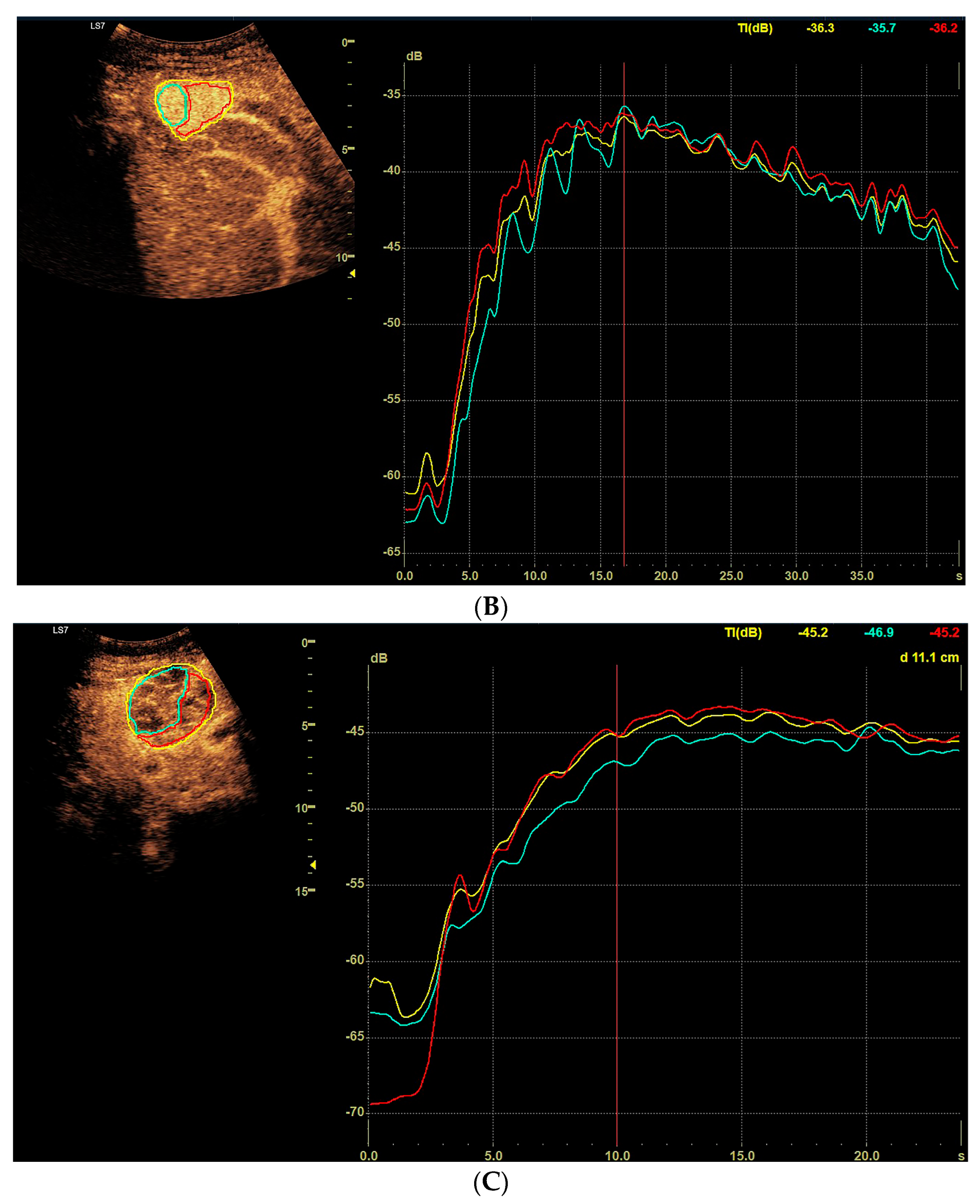 Usefulness of Contrast-Enhanced Ultrasound in the Differentiation ...