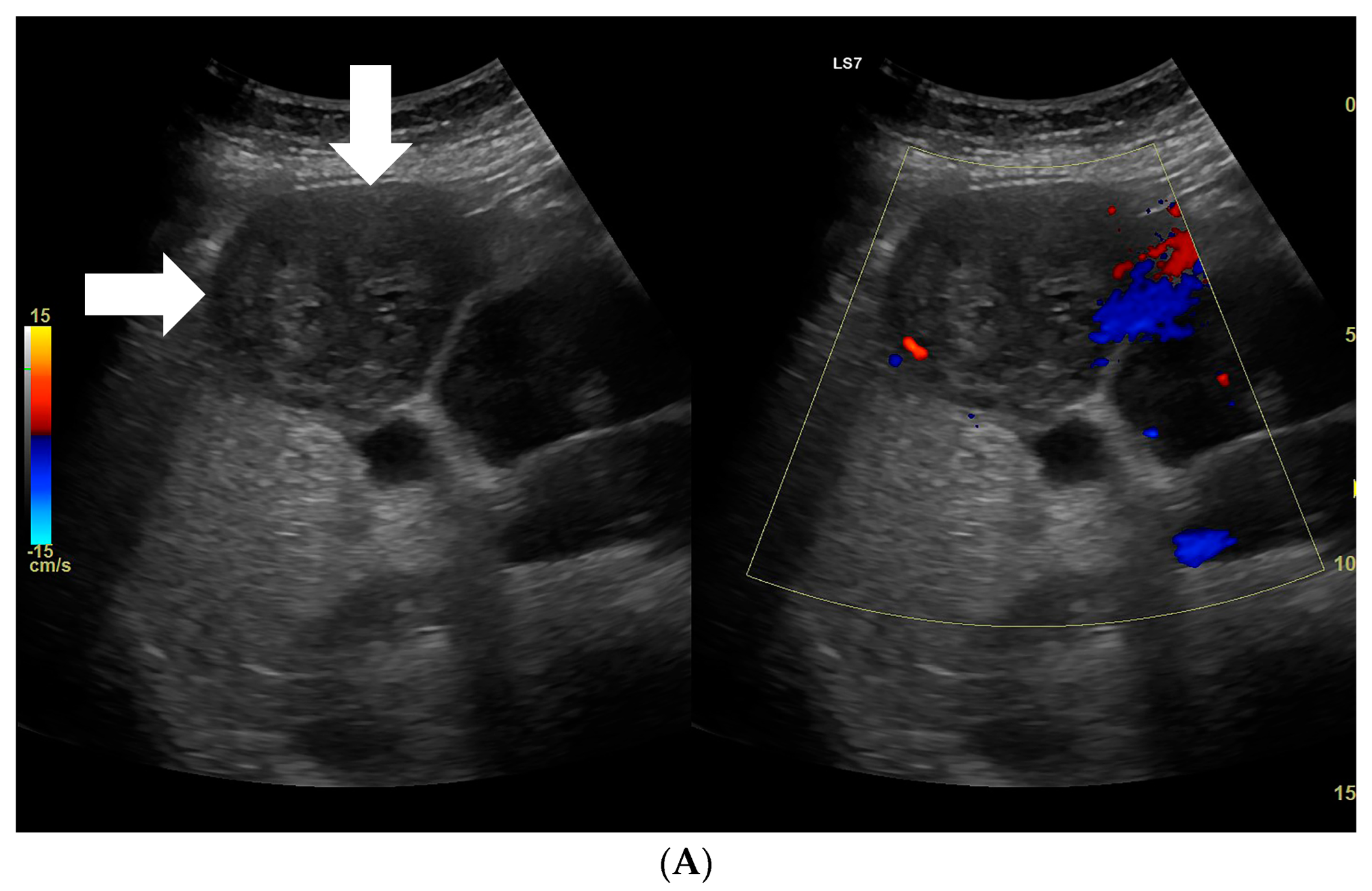 Usefulness of Contrast-Enhanced Ultrasound in the Differentiation ...