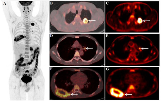 Dynamic and Static 18F-FDG PET/CT Imaging in SMARCA4-Deficient Non-Small Cell Lung Cancer and ...