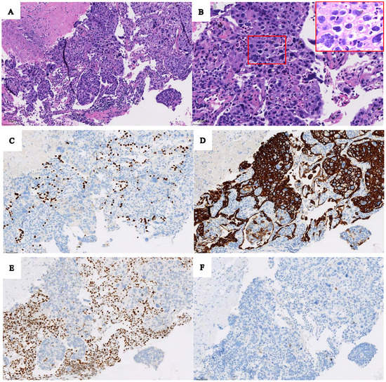 Dynamic and Static 18F-FDG PET/CT Imaging in SMARCA4-Deficient Non-Small Cell Lung Cancer and ...