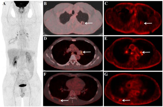 Dynamic and Static 18F-FDG PET/CT Imaging in SMARCA4-Deficient Non-Small Cell Lung Cancer and ...