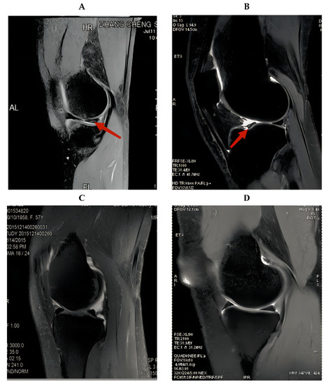 Mri Knee Meniscus