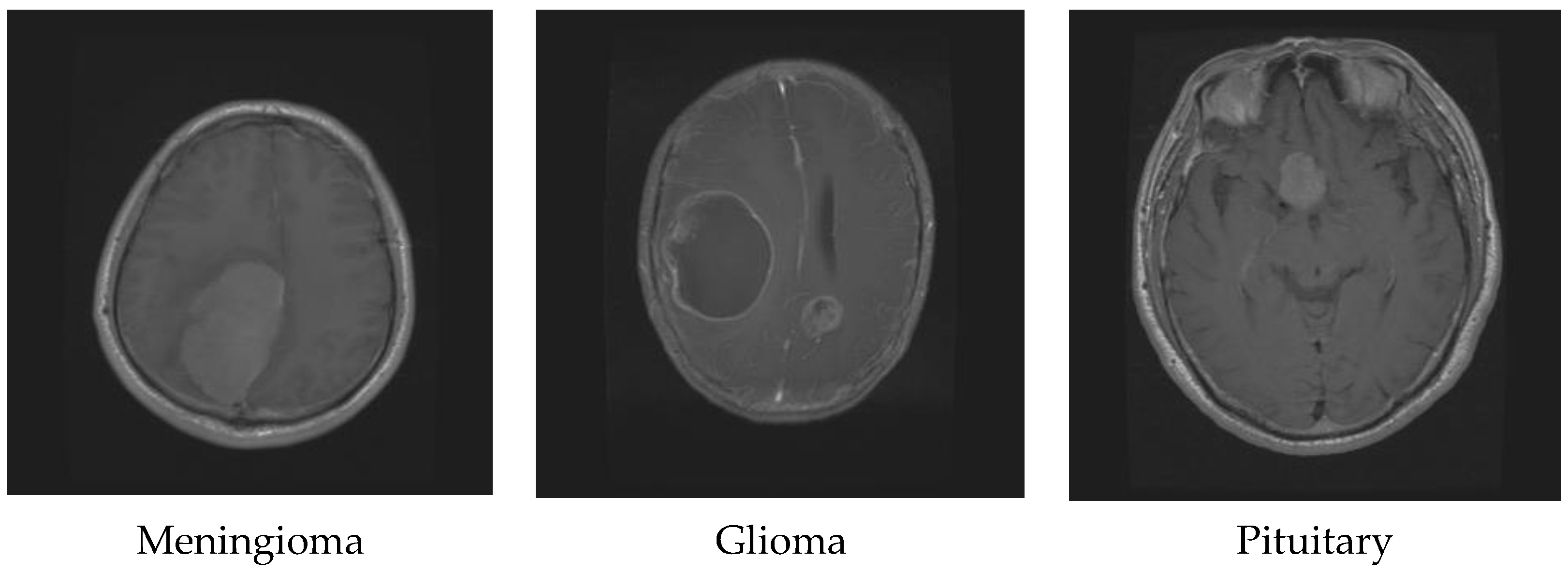 Dual Deep CNN for Tumor Brain Classification