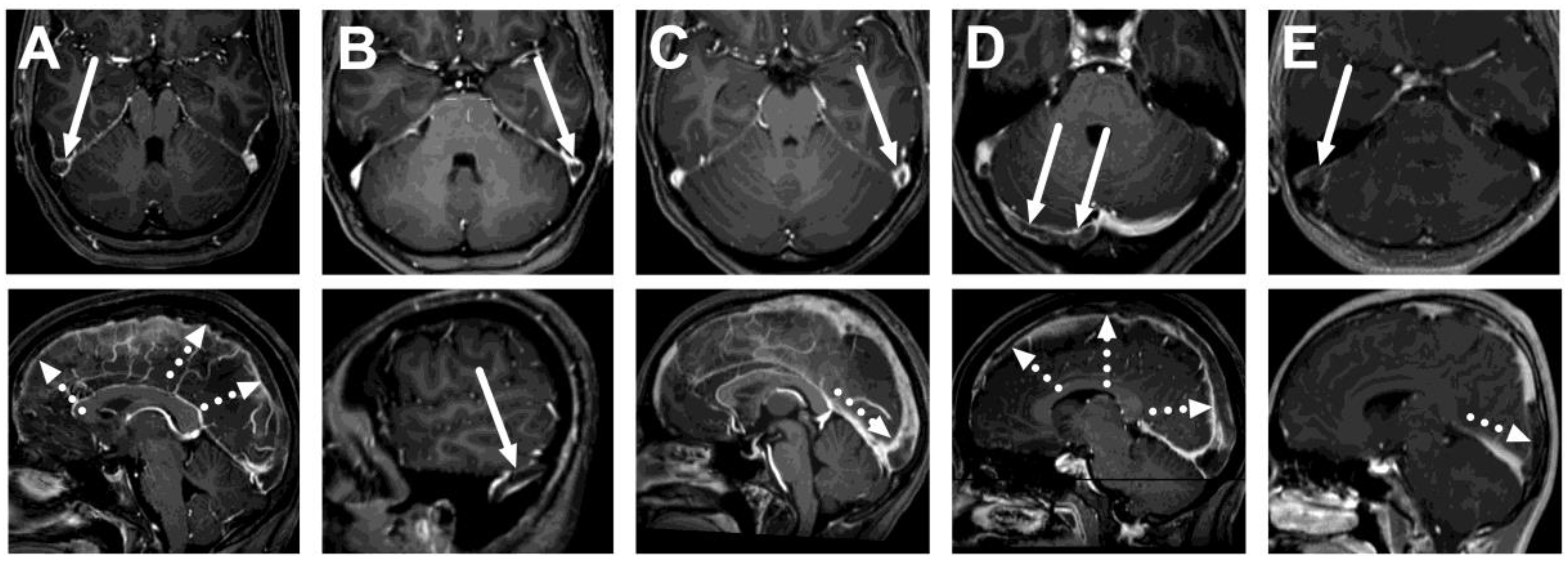 Cureus Cerebral Venous Thrombosis At High Altitude A
