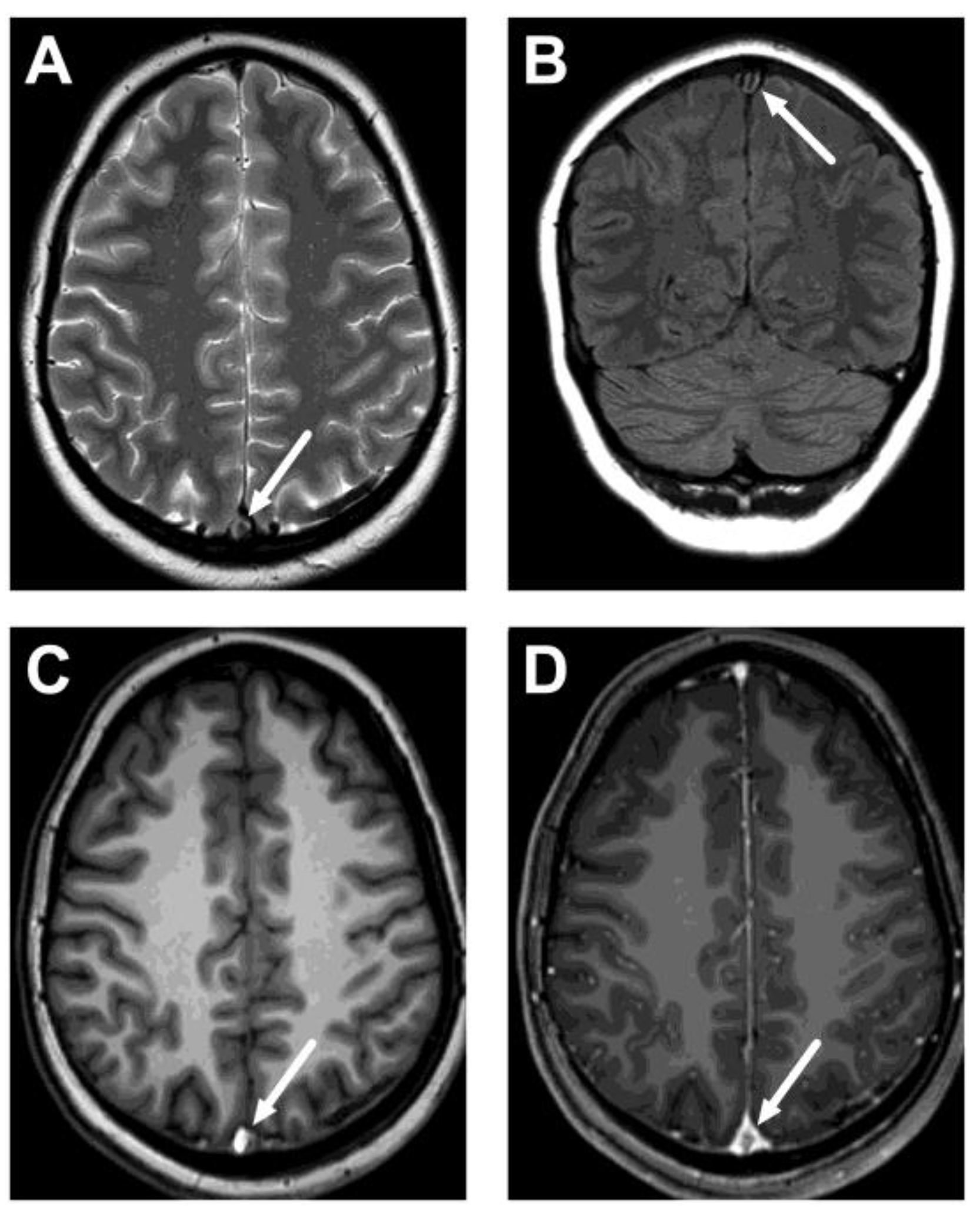 Imaging Outcomes of Emergency MRI in Patients with Suspected Cerebral ...
