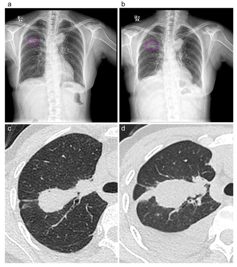 Estimating the Volume of Nodules and Masses on Serial Chest Radiography Using a Deep-Learning ...