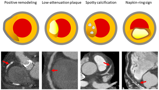 Non-Contrast and Contrast-Enhanced Cardiac Computed Tomography Imaging in the Diagnostic and ...