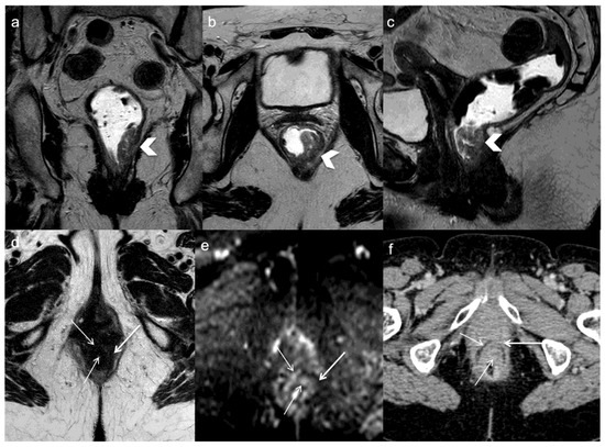 Local Recurrences in Rectal Cancer: MRI vs. CT