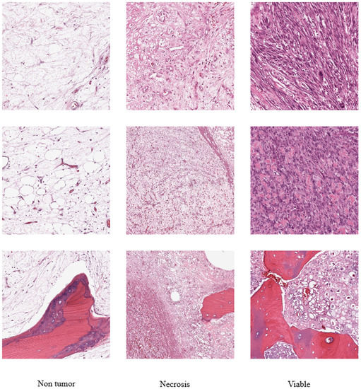 A Novel Hybrid Approach for Classifying Osteosarcoma Using Deep Feature Extraction and ...