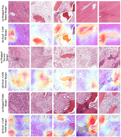 A Novel Hybrid Approach for Classifying Osteosarcoma Using Deep Feature Extraction and ...