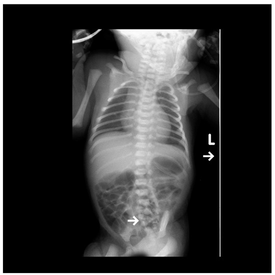 Congenital Anterior Dislocation of the Sacrococcygeal Bone in a Newborn