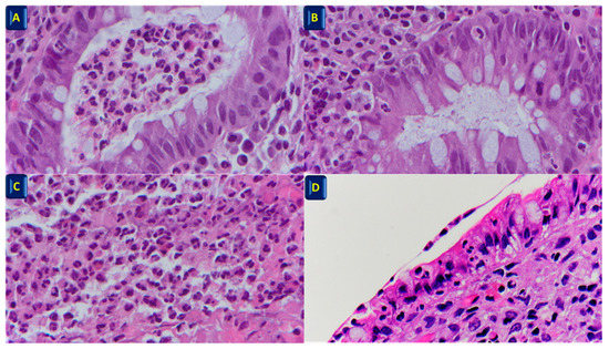 Inflammatory Bowel Diseases: Does One Histological Score Fit All?