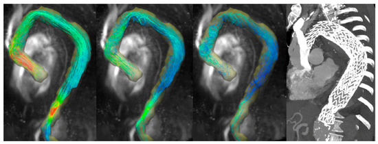 Four-Dimensional Flow MRI for the Evaluation of Aortic Endovascular Graft: A Pilot Study