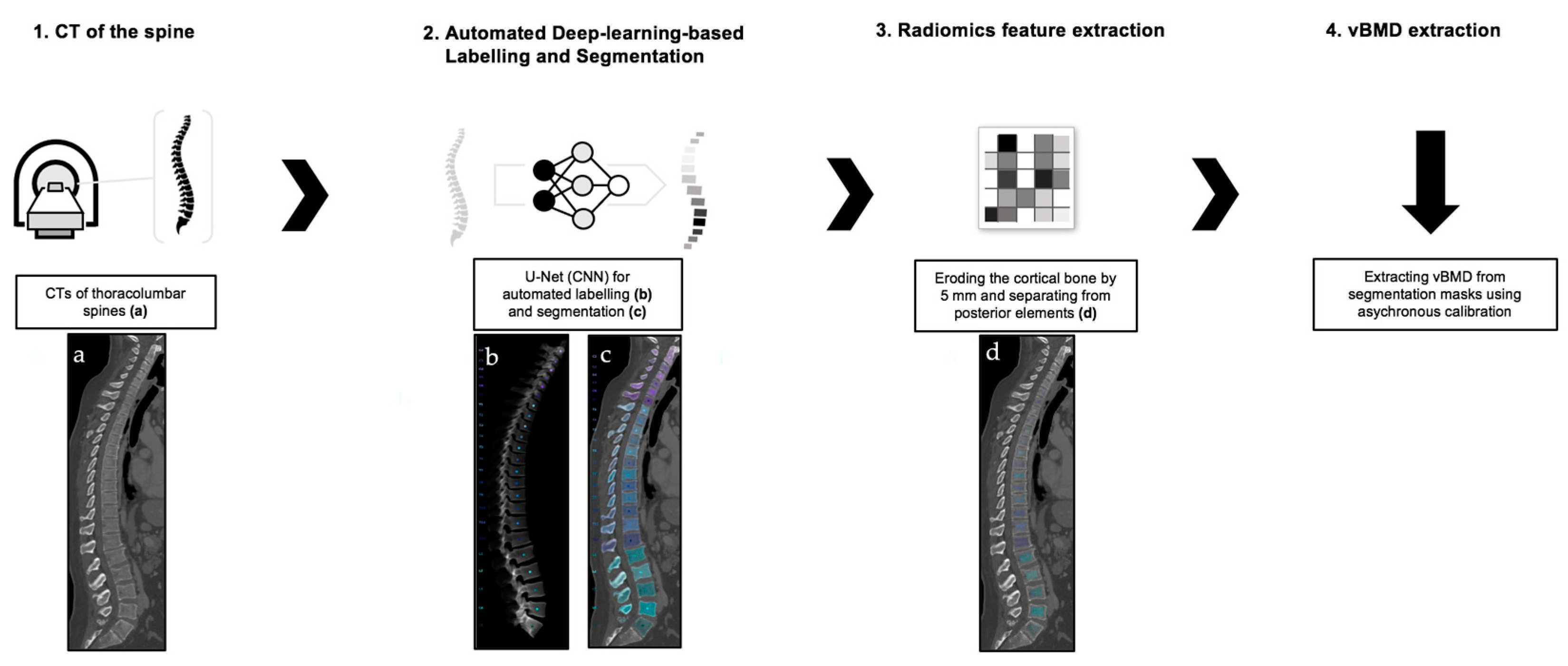 Automated Opportunistic Trabecular Volumetric Bone Mineral Density Extraction Outperforms Manual ...