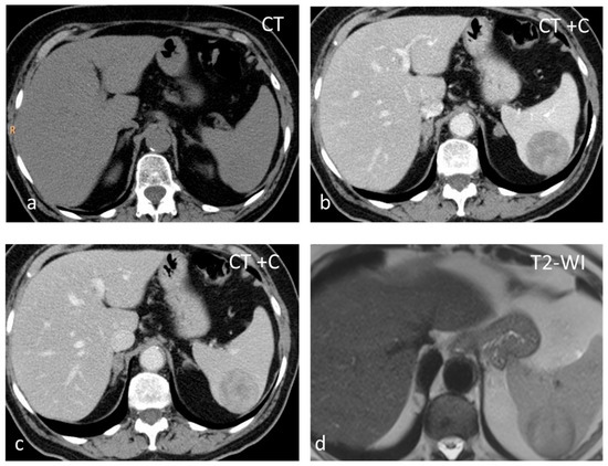 The Spectrum of Solitary Benign Splenic Lesions—Imaging Clues for a ...