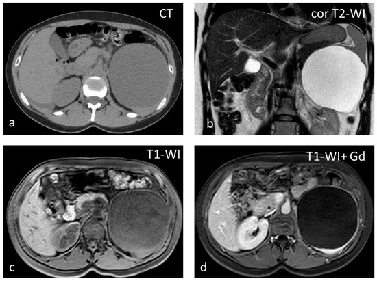 The Spectrum of Solitary Benign Splenic Lesions—Imaging Clues for a ...