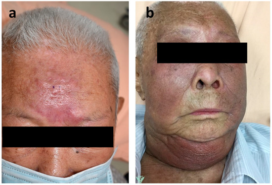 Cytological Features of a Metastatic Angiosarcoma in the Lymph Node ...