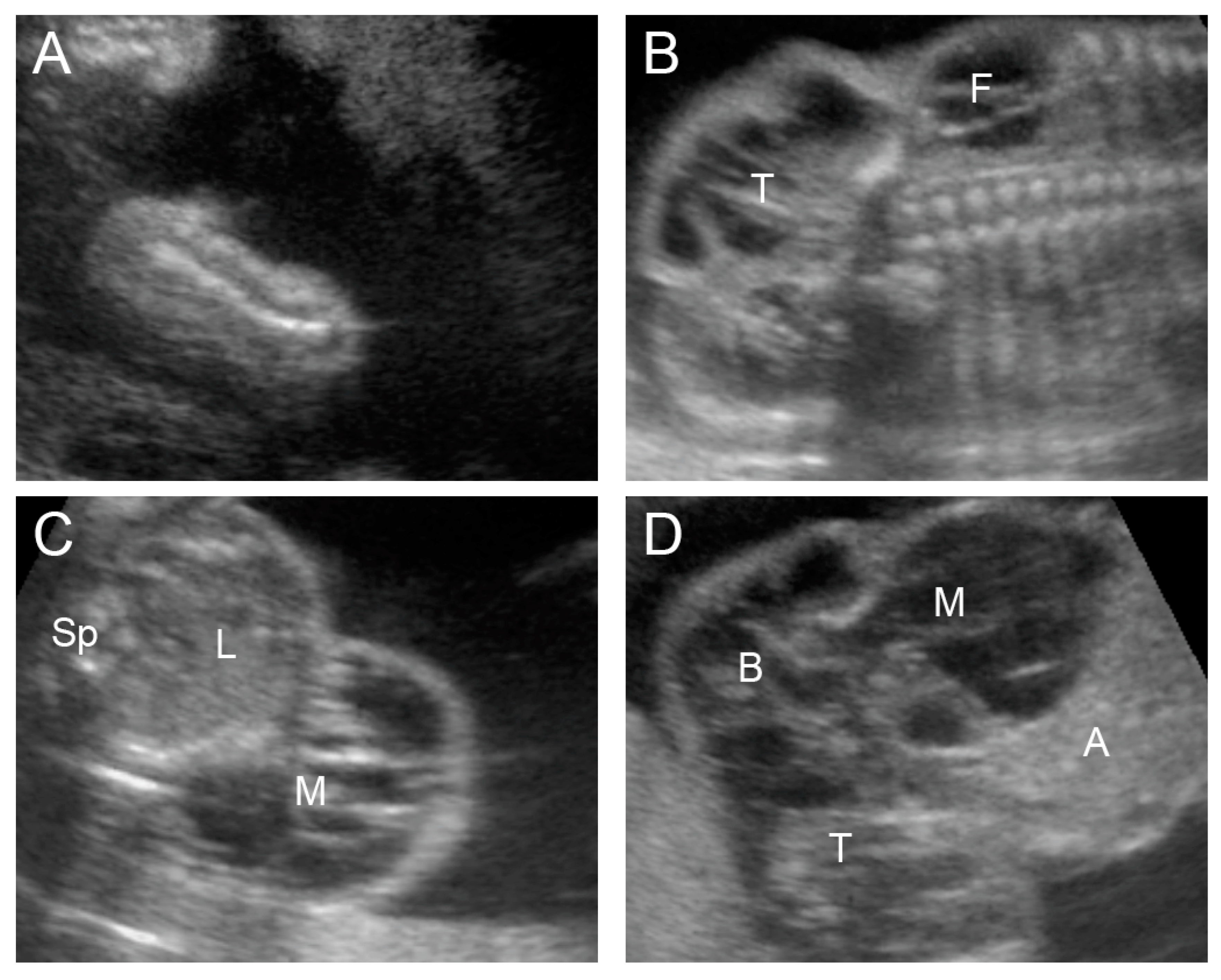 Prenatal Detection of Rapid Progressive Changes in Massive Lymphangioma ...