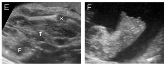 Prenatal Detection of Rapid Progressive Changes in Massive Lymphangioma ...