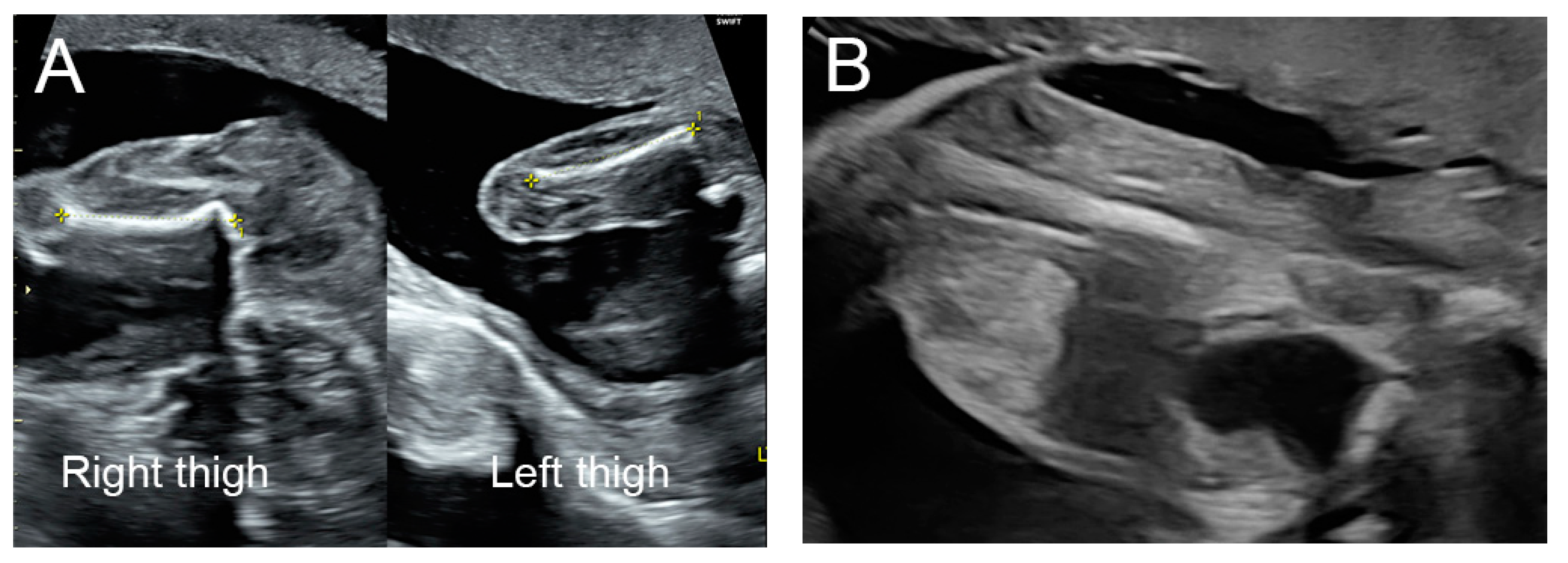 Prenatal Detection of Rapid Progressive Changes in Massive Lymphangioma ...