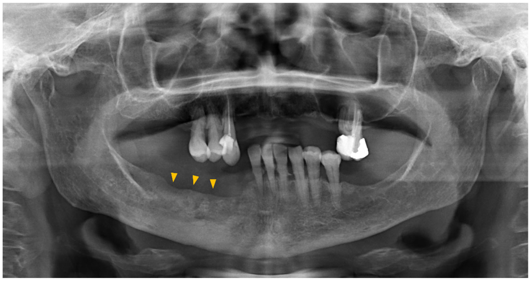 Diagnostics | Free Full-Text | Medication-Related Osteonecrosis of the ...