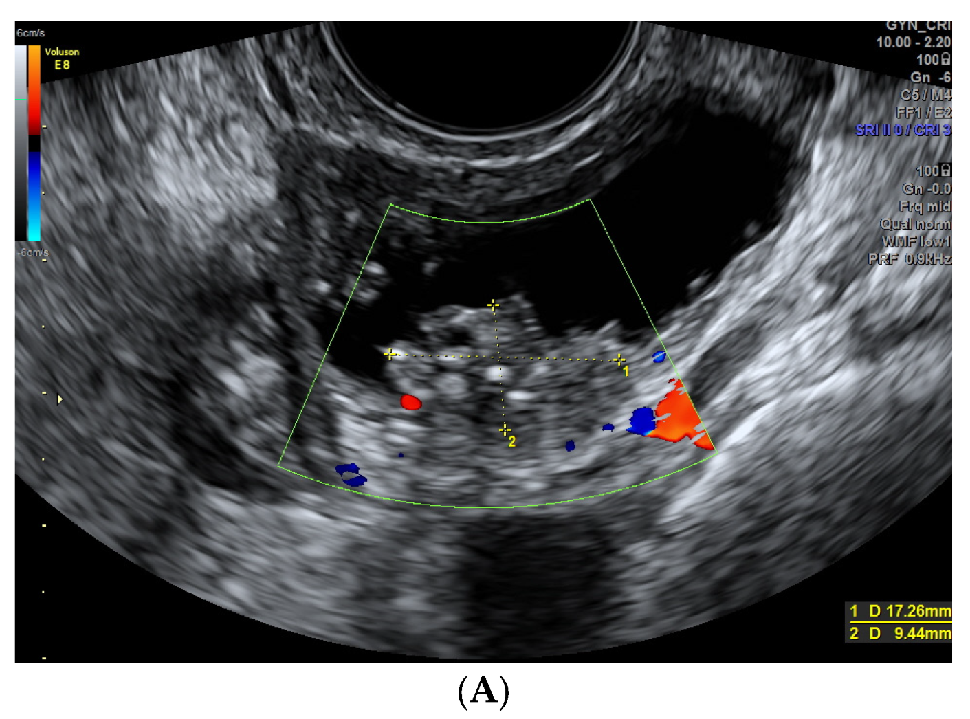Ultrasound Features and Ultrasound Scores in the Differentiation between Benign and Malignant ...