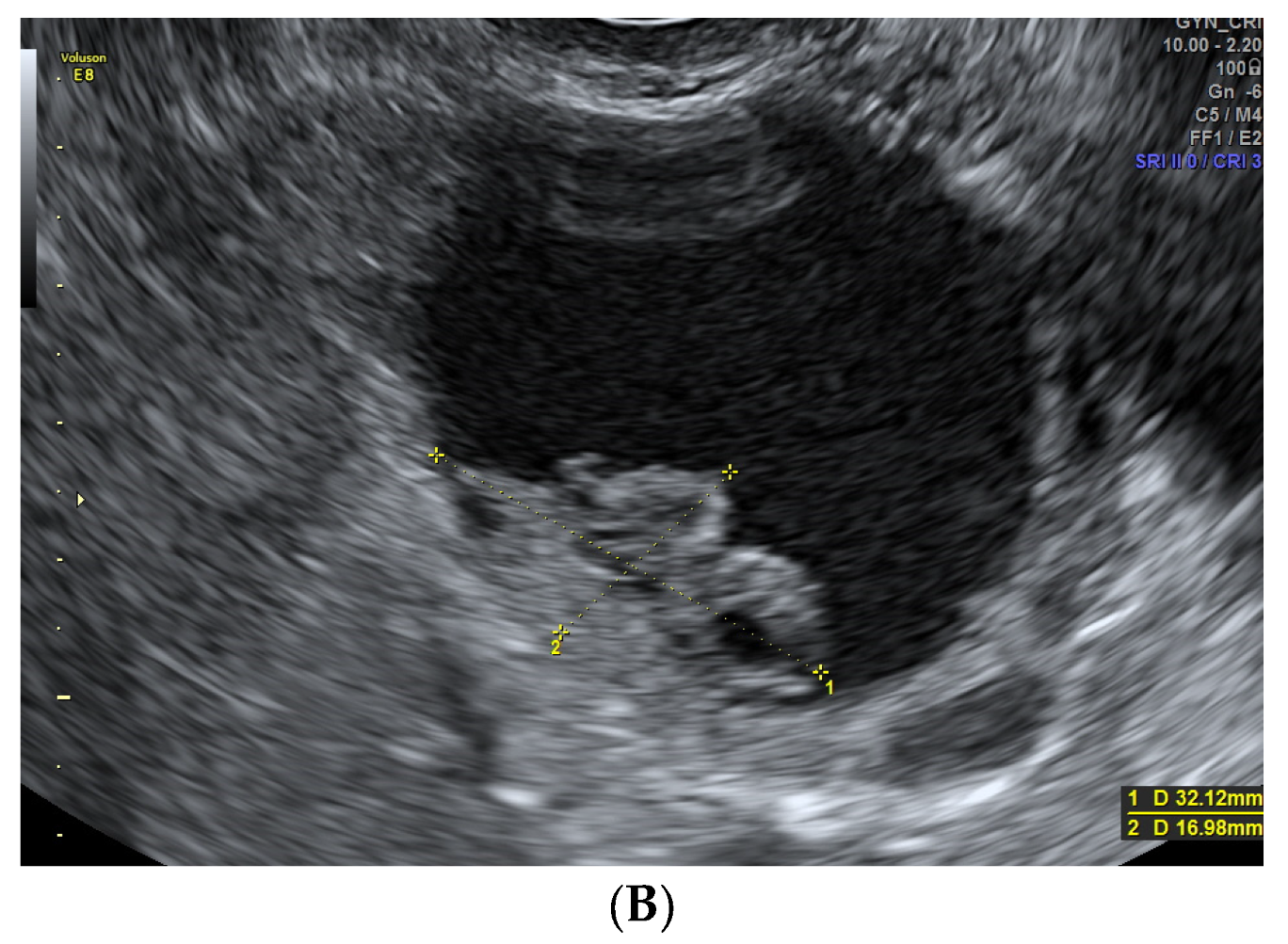 Ultrasound Features and Ultrasound Scores in the Differentiation between Benign and Malignant ...