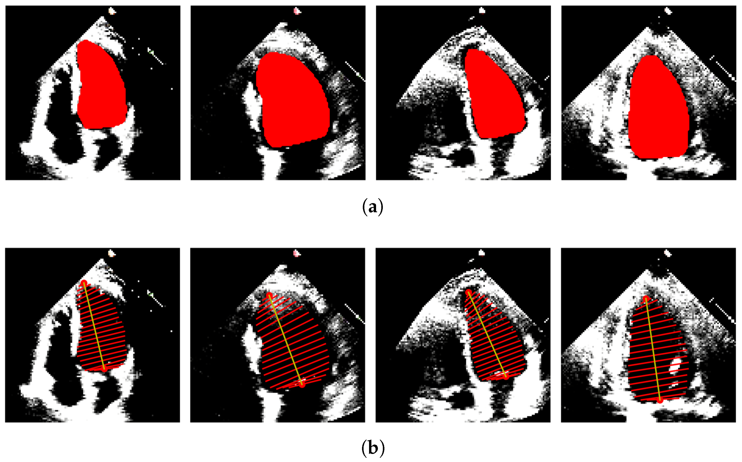 Ejection Fraction Estimation from Echocardiograms Using Optimal Left ...