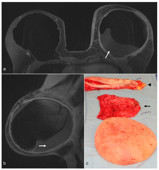 Imaging Features Following Breast Explant Surgery: A Pictorial Essay