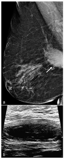 Imaging Features Following Breast Explant Surgery: A Pictorial Essay