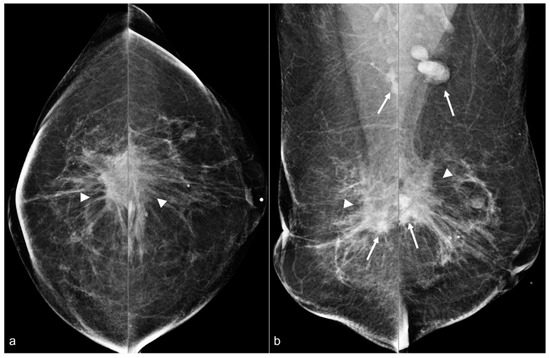 Imaging Features Following Breast Explant Surgery: A Pictorial Essay
