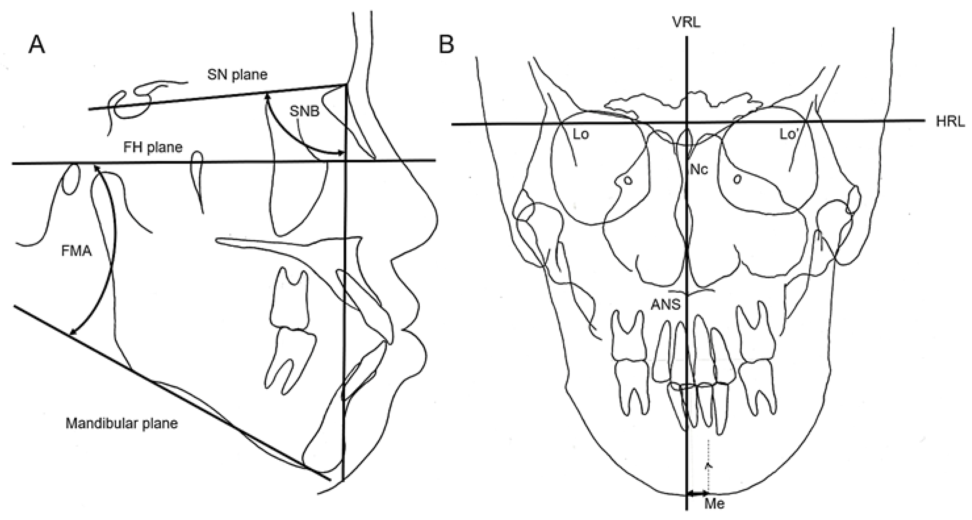 Association between the Temporomandibular Joint Morphology and Chewing ...