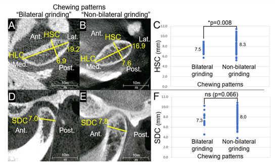 Association between the Temporomandibular Joint Morphology and Chewing ...