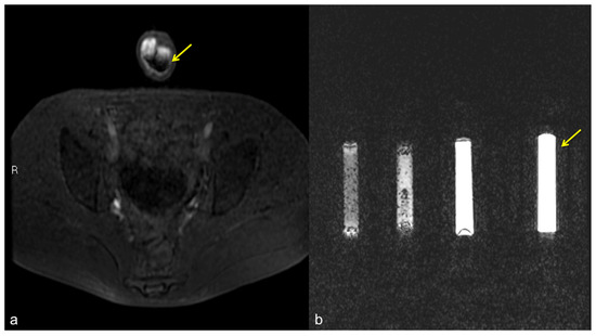 MRI-Cavernosography: A New Diagnostic Tool for Erectile Dysfunction Due ...