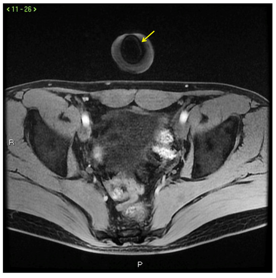 MRI-Cavernosography: A New Diagnostic Tool for Erectile Dysfunction Due ...
