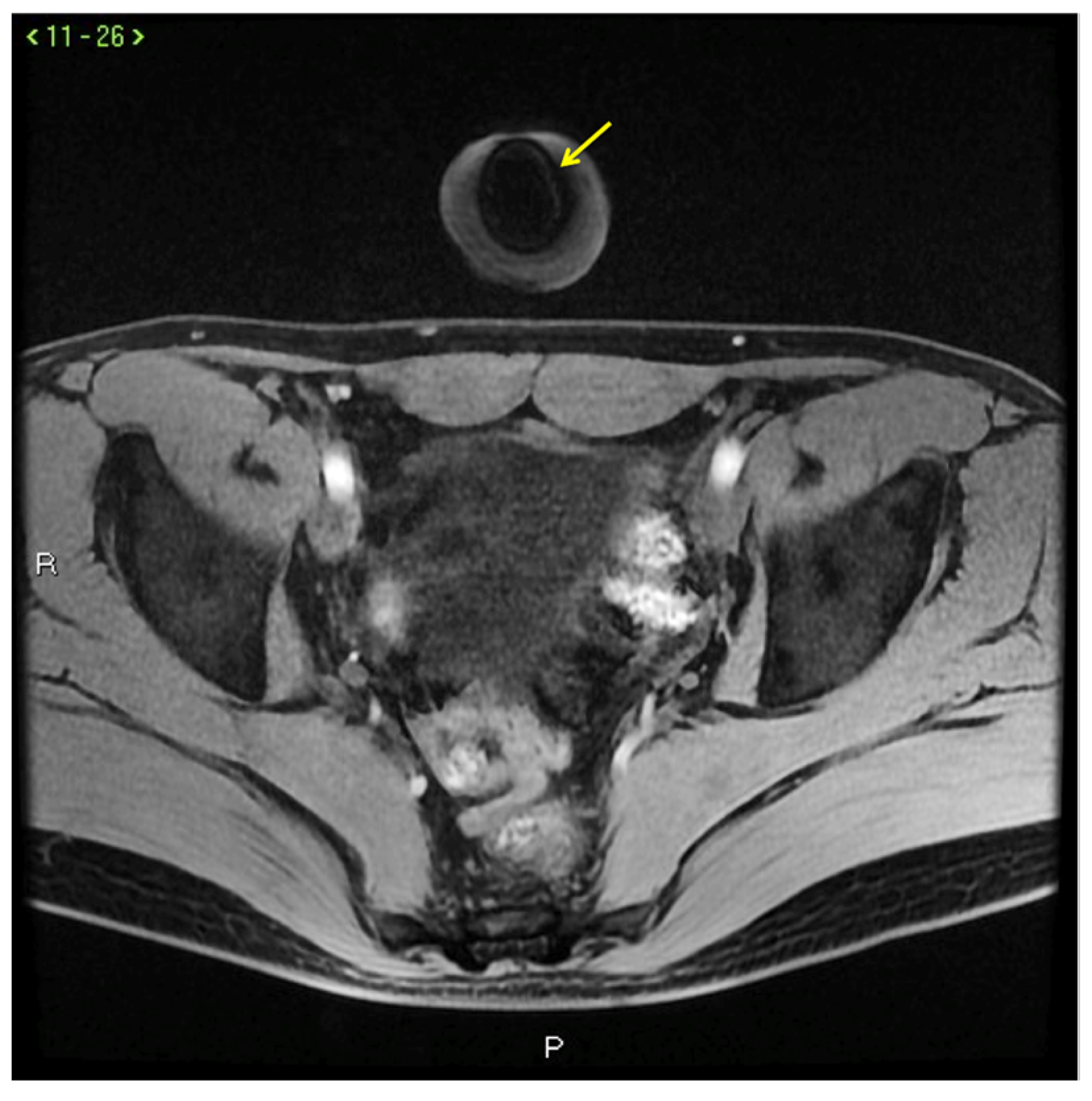 MRI-Cavernosography: A New Diagnostic Tool for Erectile Dysfunction Due ...
