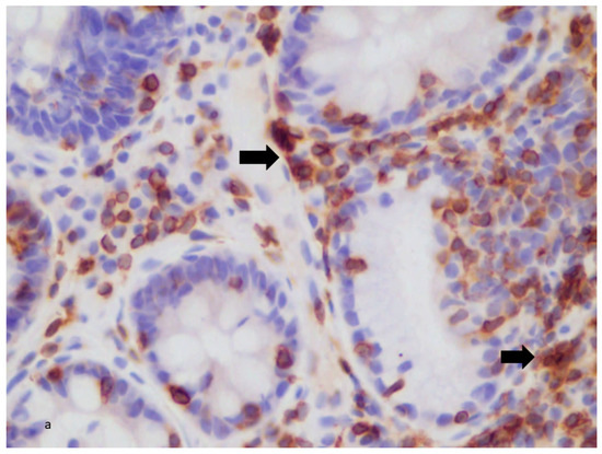 Diagnostics | Free Full-Text | Expression of IL-21 and IL-33 in ...