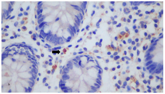 Diagnostics | Free Full-Text | Expression of IL-21 and IL-33 in ...