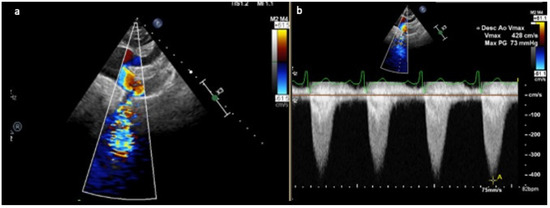 Coarctation of the Aorta: Diagnosis and Management