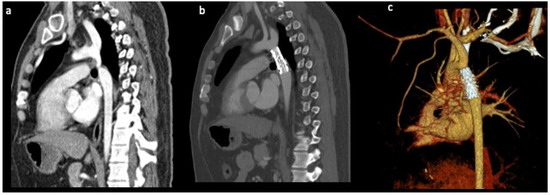 Coarctation of the Aorta: Diagnosis and Management