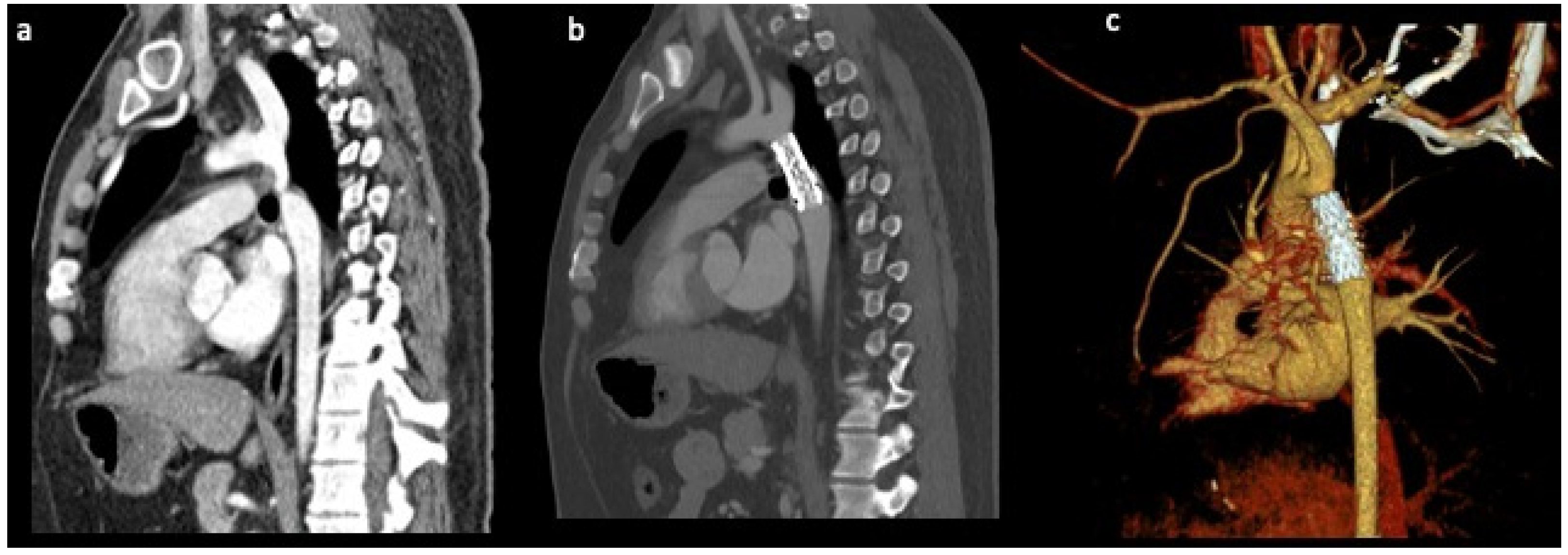 Coarctation of the Aorta: Diagnosis and Management