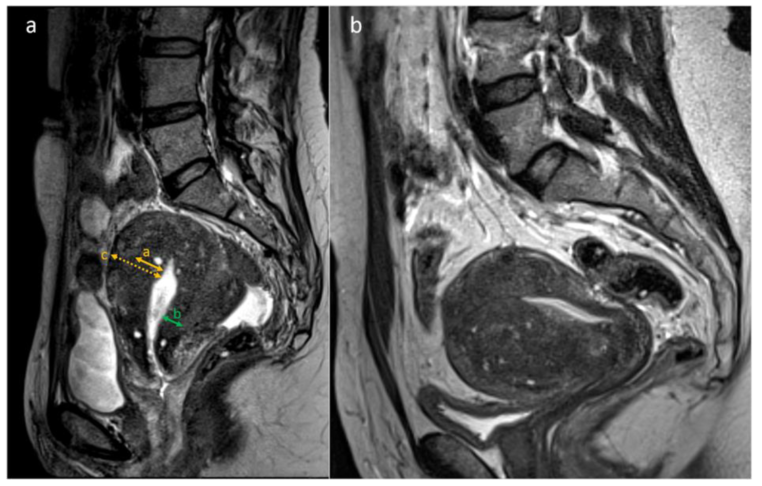 Uterus Anatomy Mri