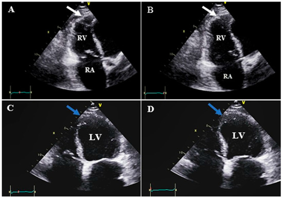 Two-Dimensional Transthoracic Echocardiography-Based Diagnosis of Right ...