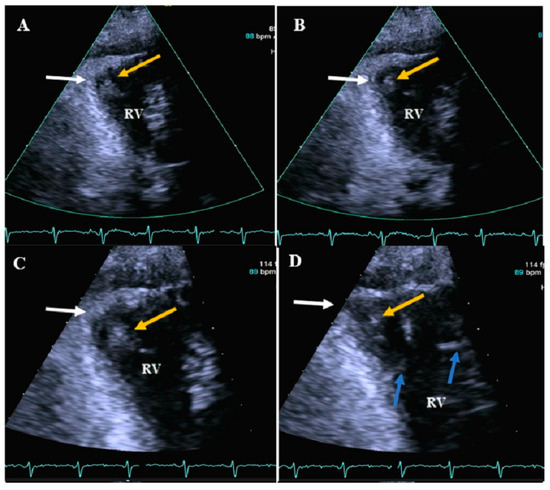 Two-Dimensional Transthoracic Echocardiography-Based Diagnosis of Right ...