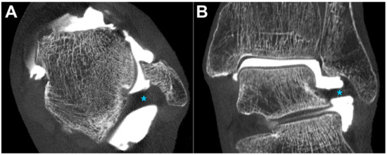 Ultra-High-Resolution Photon-Counting Detector CT Arthrography of the ...