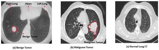 ExtRanFS: An Automated Lung Cancer Malignancy Detection System Using Extremely Randomized ...