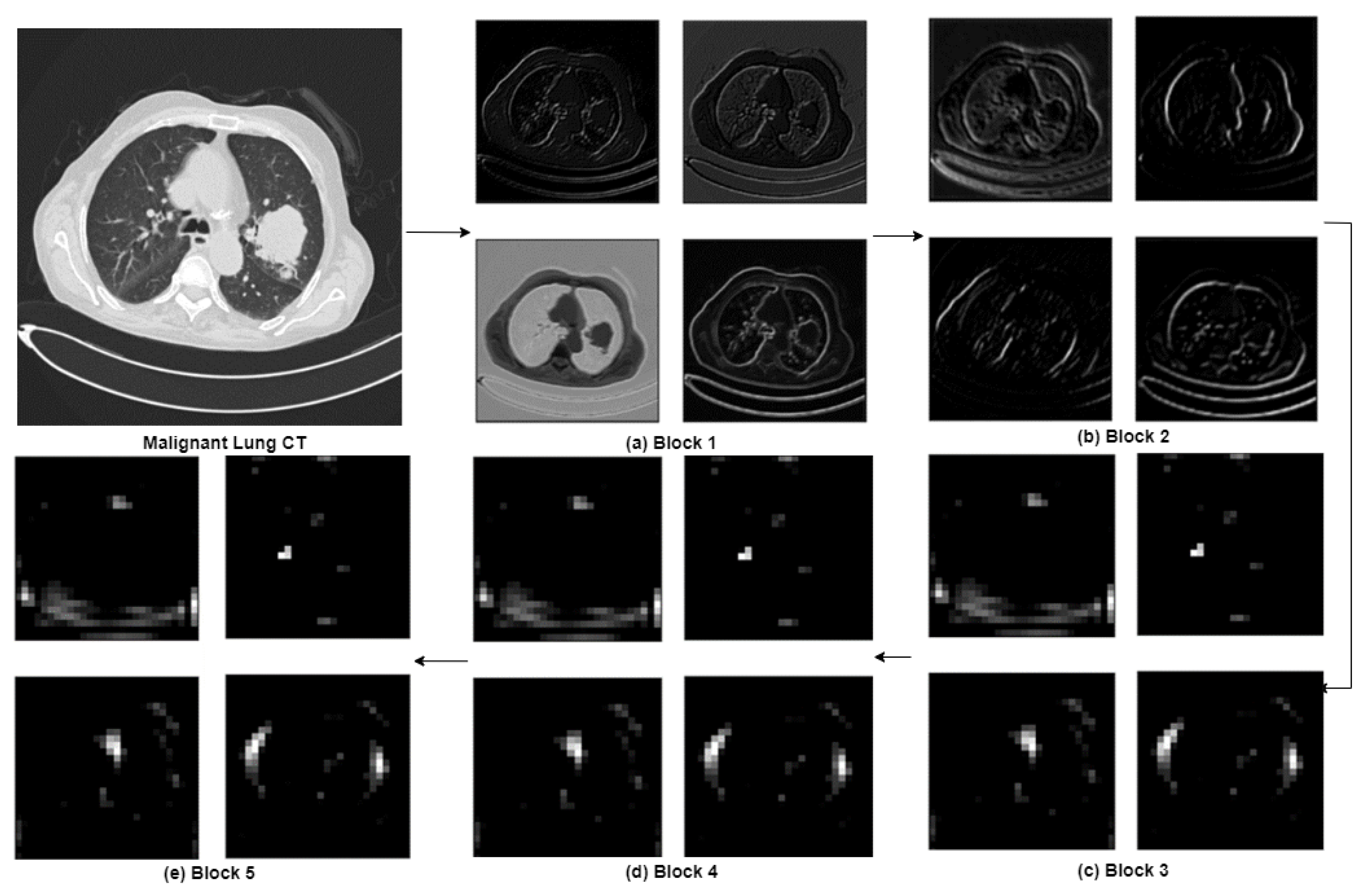 ExtRanFS: An Automated Lung Cancer Malignancy Detection System Using Extremely Randomized ...