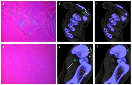 Impact of Dual-Energy Computed Tomography (DECT) Postprocessing ...